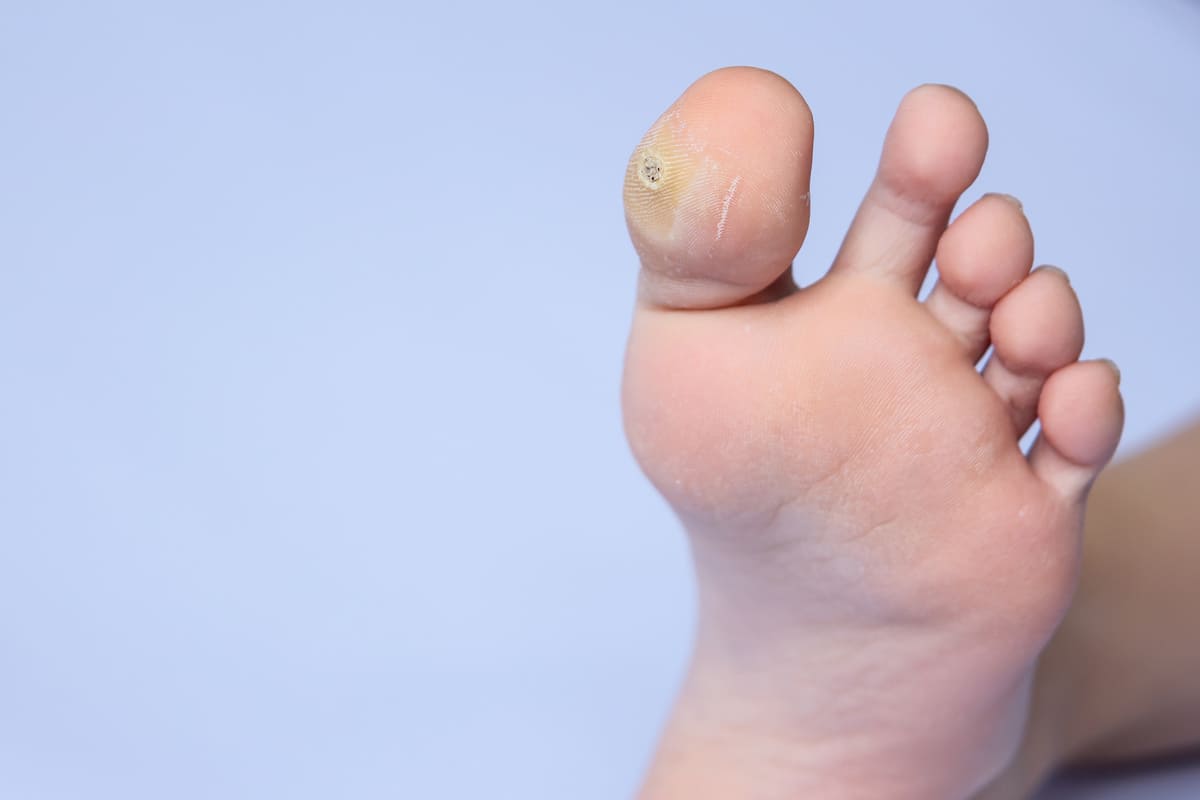 ¿Cómo es un papiloma en el pie y cuál es su tratamiento? - Aiudo Servicios